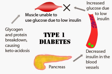 Genetics breakthrough is a game changer for type 1 diabetes research ...