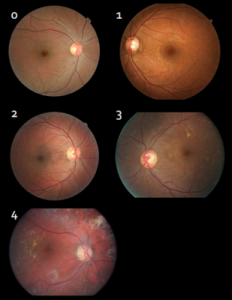 Deep learning on Amazon Cloud used to Improve Diagnosis of chronic eye ...