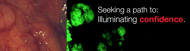 Flourescent biotechnology for high lighting solid cancer for more ...