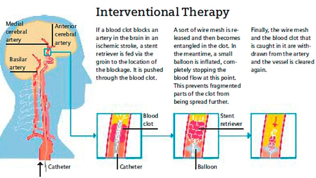Benefits of clot removal for strokes extended to 24 hours ...