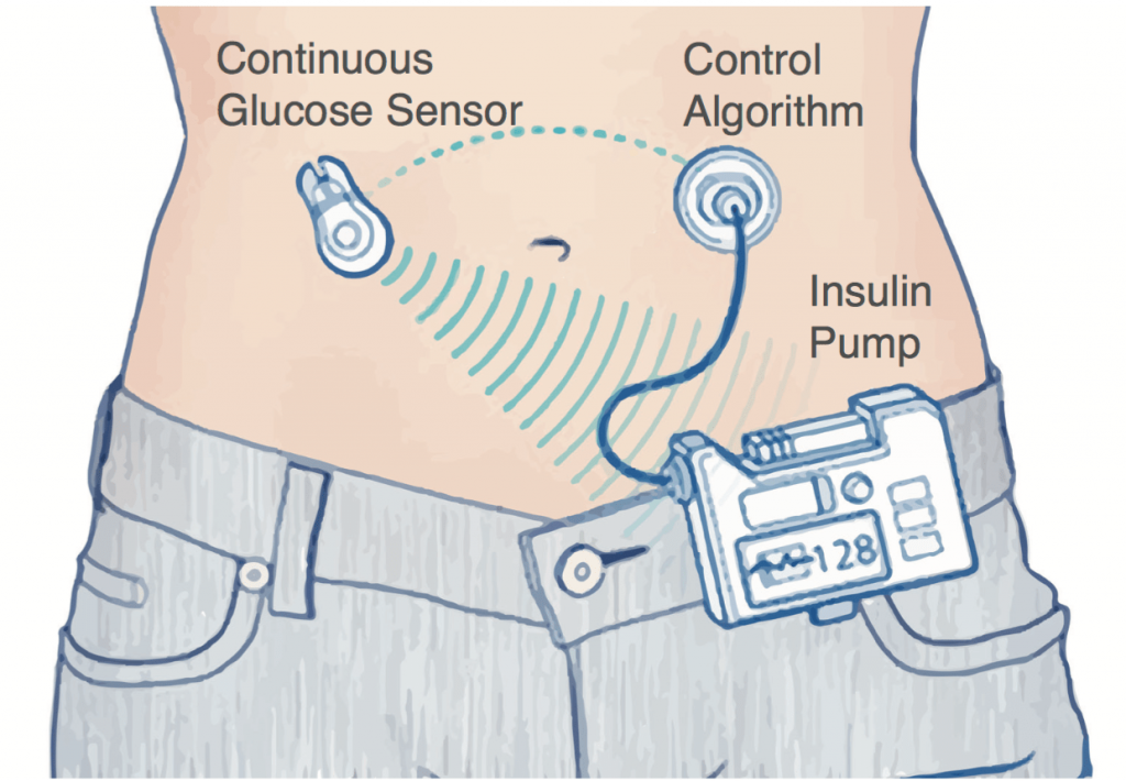Artificial pancreas shows improved results but longer studies needed to ...