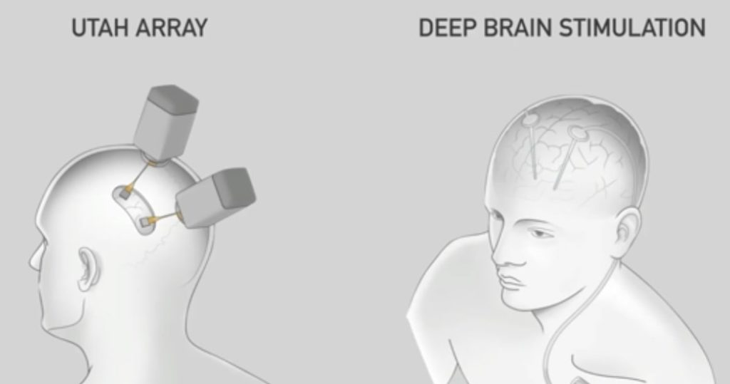Neuralink and Elon Musk Have 10,000 Electrode-Thread Brain Computer ...