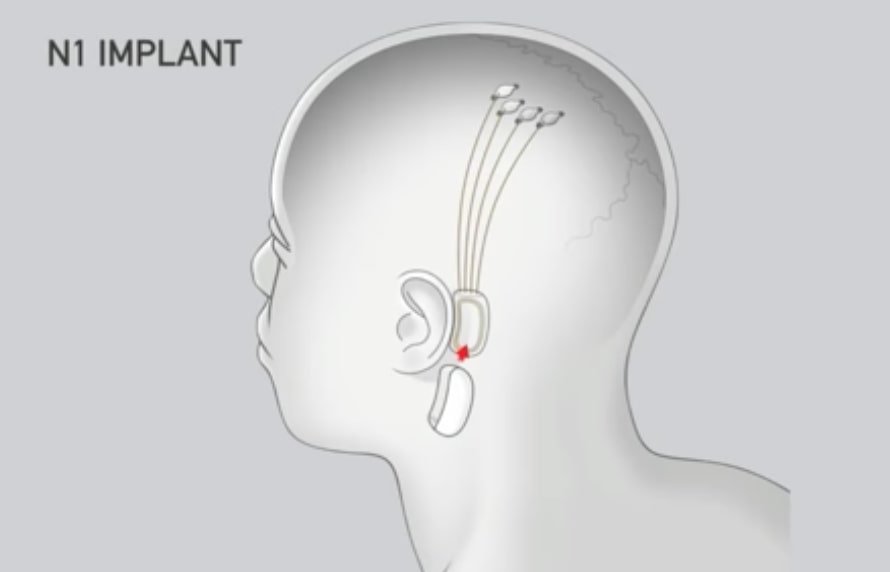 Neuralink and Elon Musk Have 10,000 Electrode-Thread Brain Computer ...