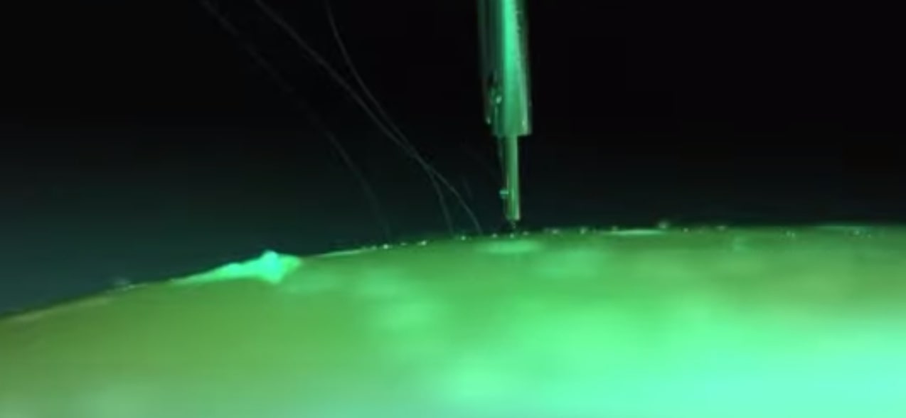 Neuralink Multi-thousand Channel Brain Interface Implantation Surgery ...