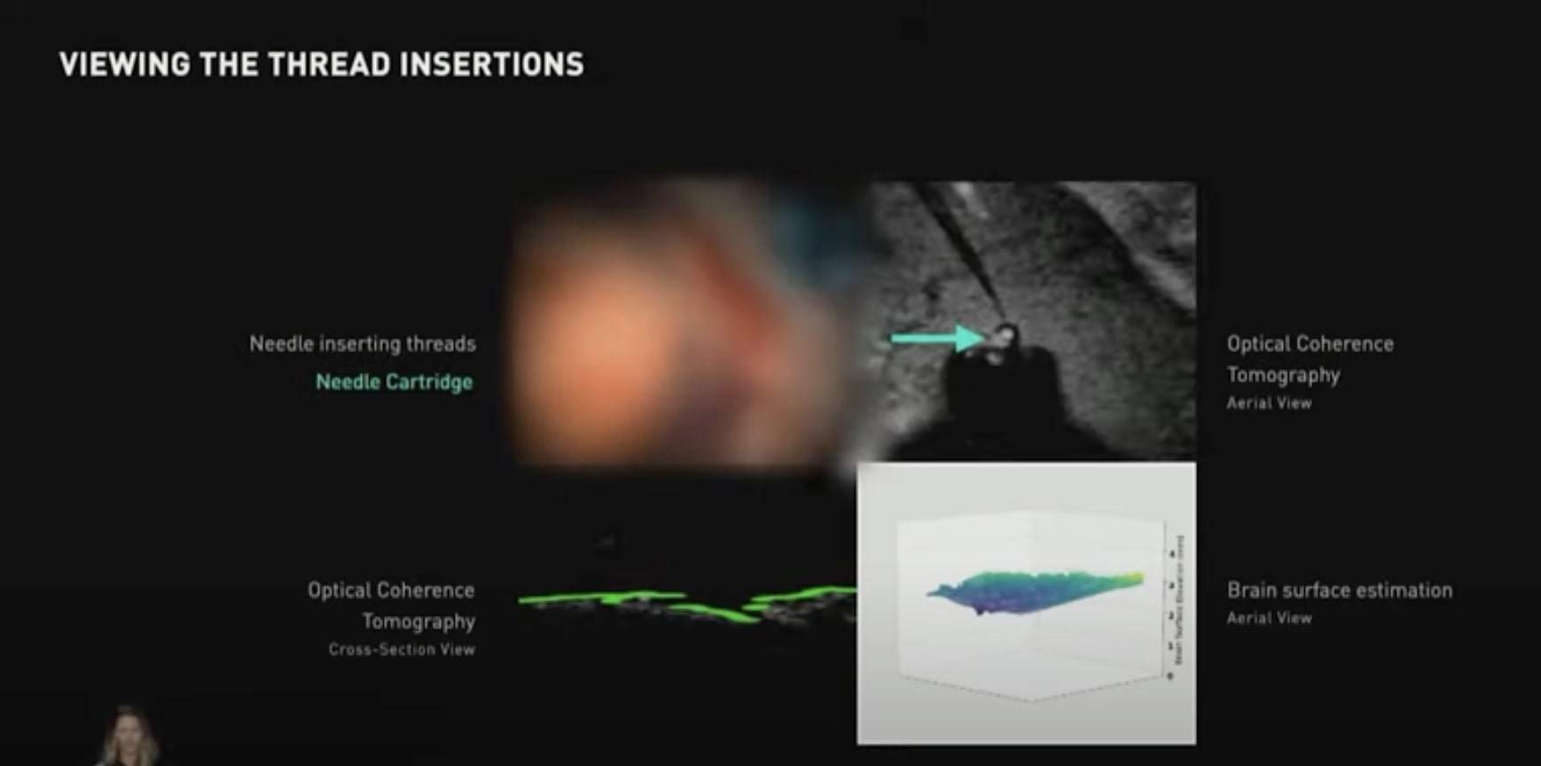 Neuralink Day Highlights a Brain Implant With Over 4000 Channels ...