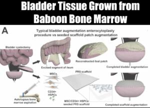 Bladder Tissue Grown Successfully from Bone Marrow | NextBigFuture.com